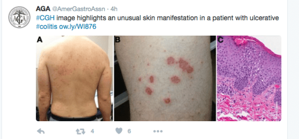 Nummular Eczema due to Infliximab | gutsandgrowth