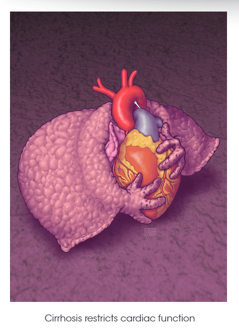 Cirrhosis and Cardiac Function | gutsandgrowth