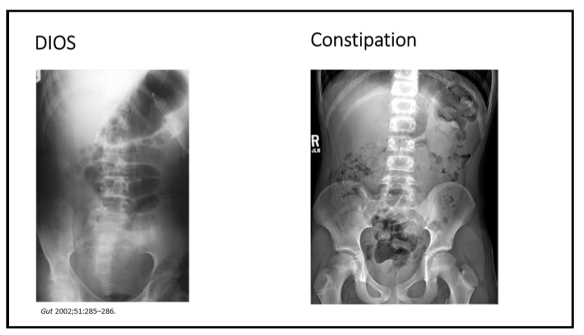 distal intestinal obstruction syndrome | gutsandgrowth