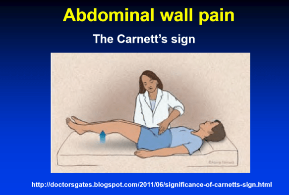 median arcuate ligament syndrome | gutsandgrowth
