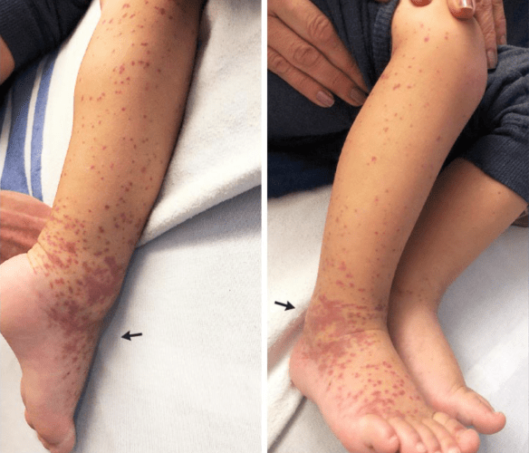 IgA Vasculitis (Henoch-Schonlein Purpura) | gutsandgrowth