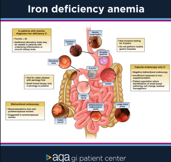 Patient Handout from AGA on Iron Deficiency Anemia | gutsandgrowth
