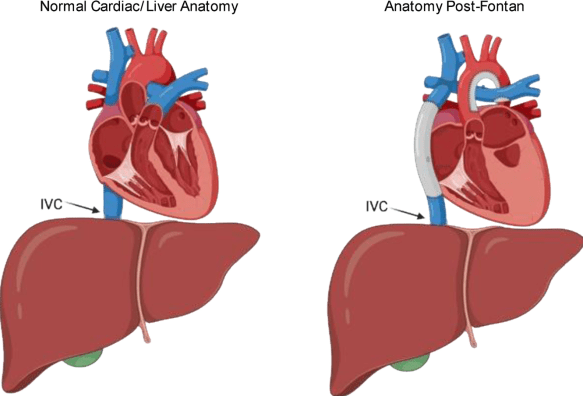 Understanding Fontan-Associated Liver Disease (FALD) | gutsandgrowth