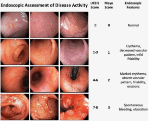 Comprehensive ACG Clinical Guidelines for Ulcerative Coliits (2025 ...