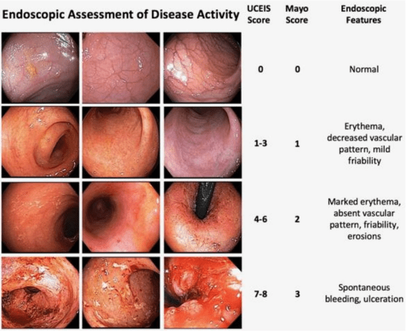 Comprehensive ACG Clinical Guidelines for Ulcerative Coliits (2025 ...