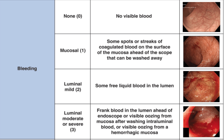 How to Score the Ulcerative Colitis Endoscopic Index of Severity (UCEIS ...