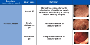 How to Score the Ulcerative Colitis Endoscopic Index of Severity (UCEIS ...