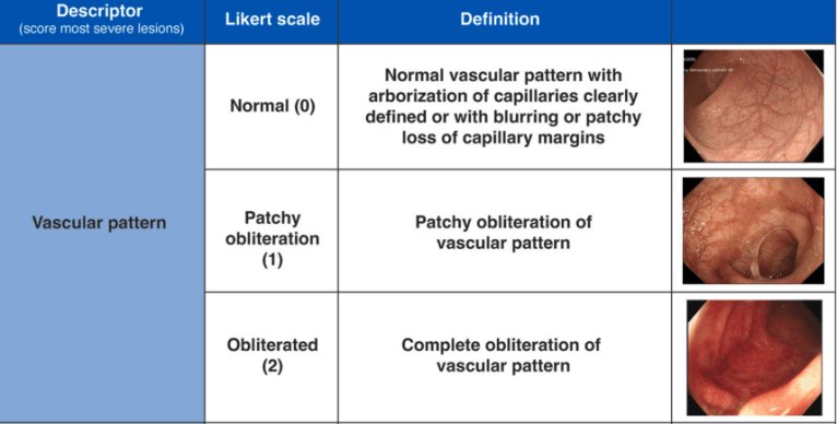 How to Score the Ulcerative Colitis Endoscopic Index of Severity (UCEIS ...